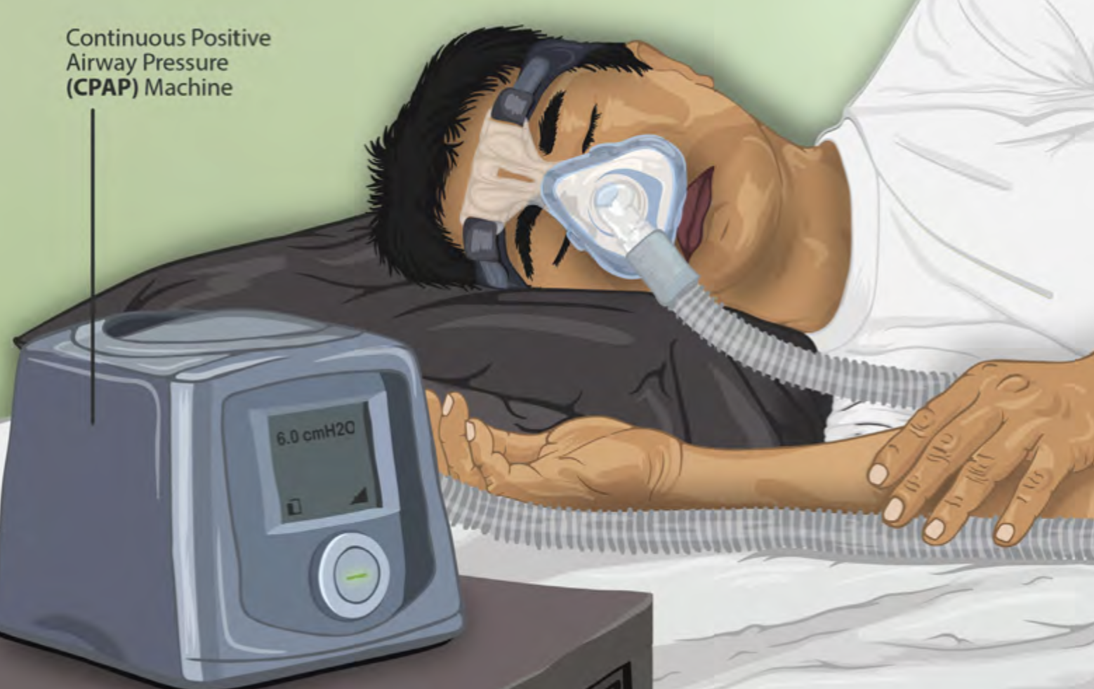 9.4 Positive Airway Pressure (CPAP) – Personal Care Skills for Health ...