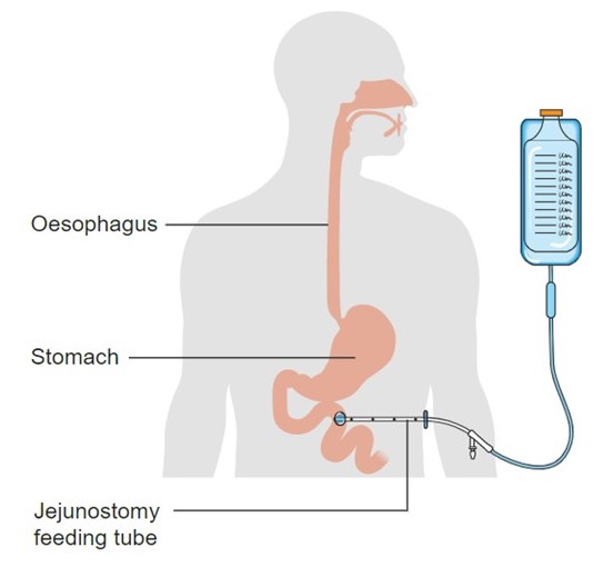 6.4 Special Diets – Personal Care Skills for Health Care Assistants