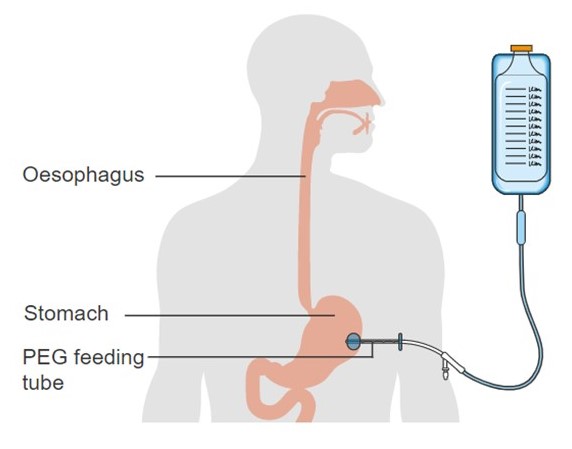 6.4 Special Diets – Personal Care Skills for Health Care Assistants